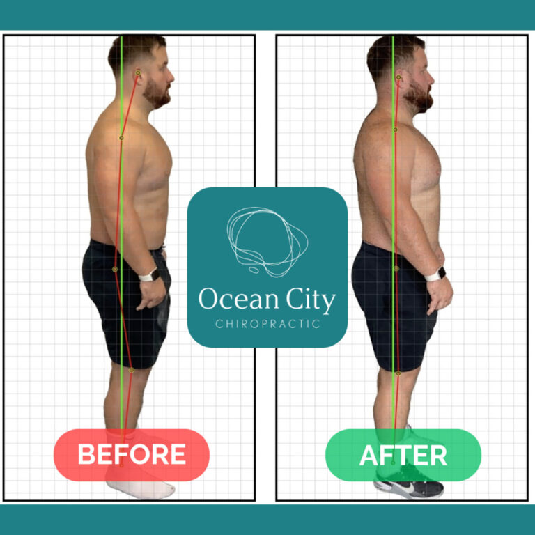 Posture Before and After a Chiropractic Adjustment • Ocean City ...